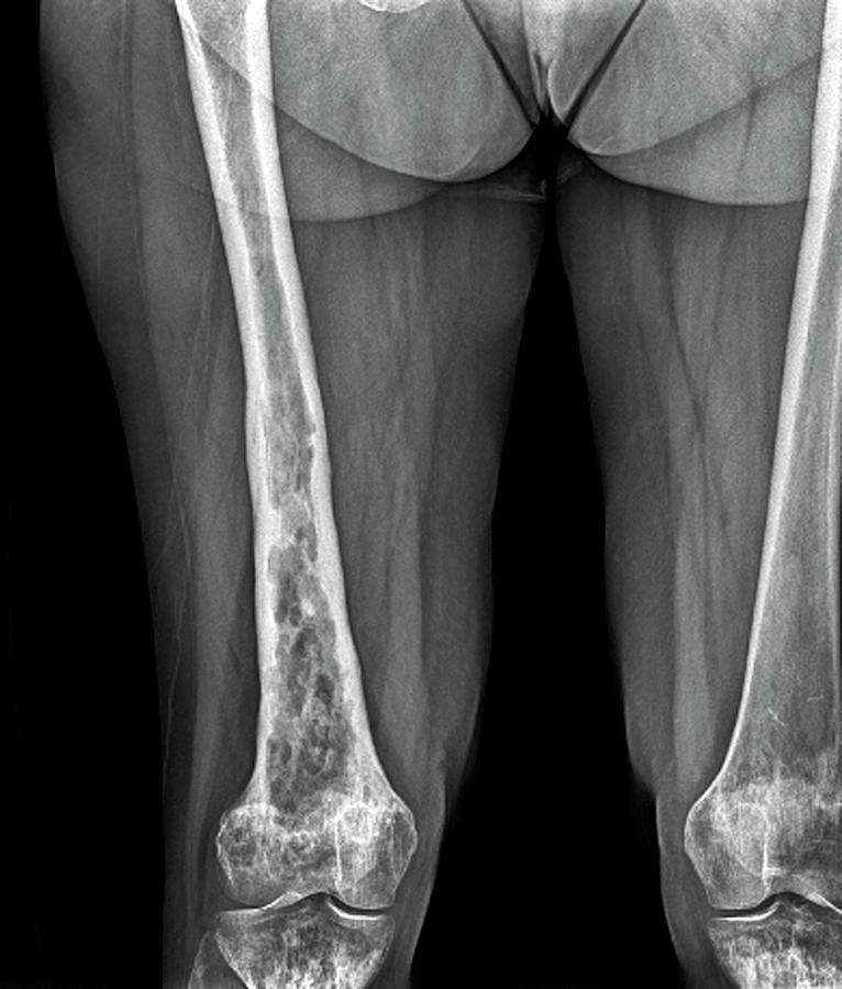 Bone Disease #1 by Zephyr / Science Photo Library