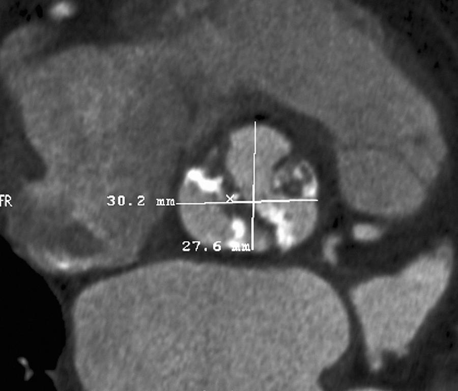 Calcified heart valve, CT scan #1 by Zephyr / Science Photo Library