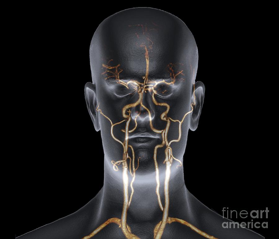 Neck And Head Arteries, Mra Scan #1 by Zephyr / Science Photo Library