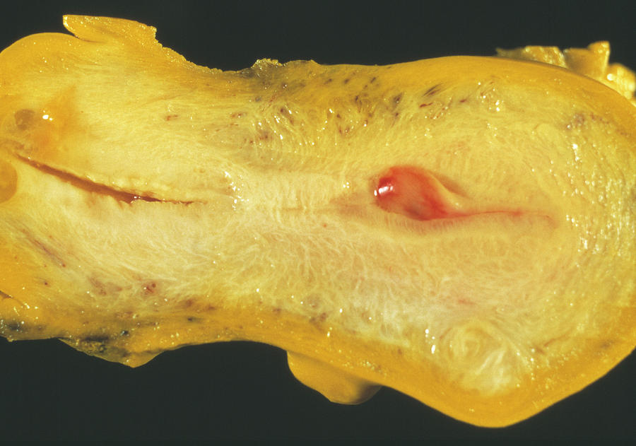 Uterine Polyp #1 by Cnri / Science Photo Library