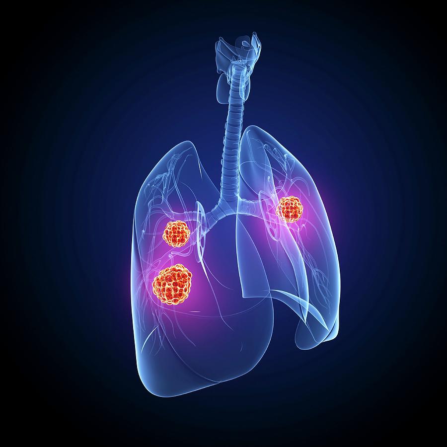 Lung Cancer #10 by Pixologicstudio / Science Photo Library