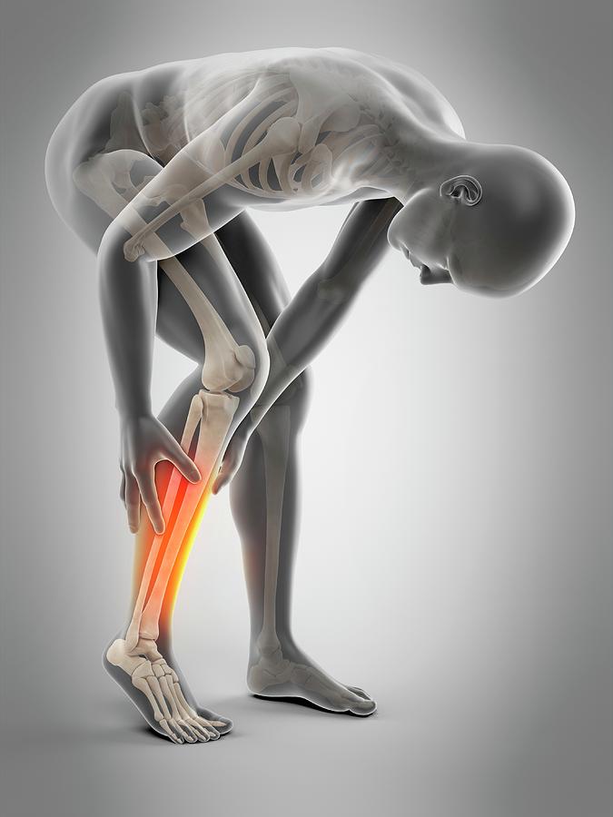 Human Calf Pain #11 by 3Dmedisphere / Science Photo Library