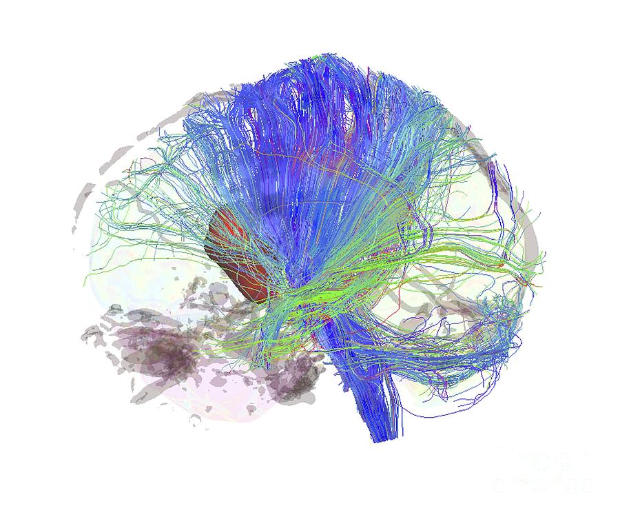 Brain Tumour, Dti Mri Scan #2 by Sherbrooke Connectivity Imaging Lab ...