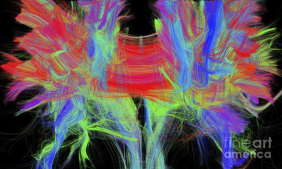 Corpus Callosum, Dti Mri Scan #2 by Sherbrooke Connectivity Imaging Lab ...