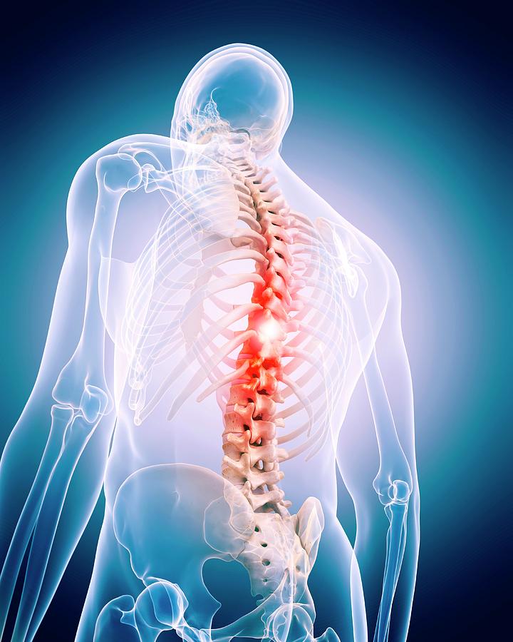 Human Spinal Pain #2 by 3Dmedisphere / Science Photo Library