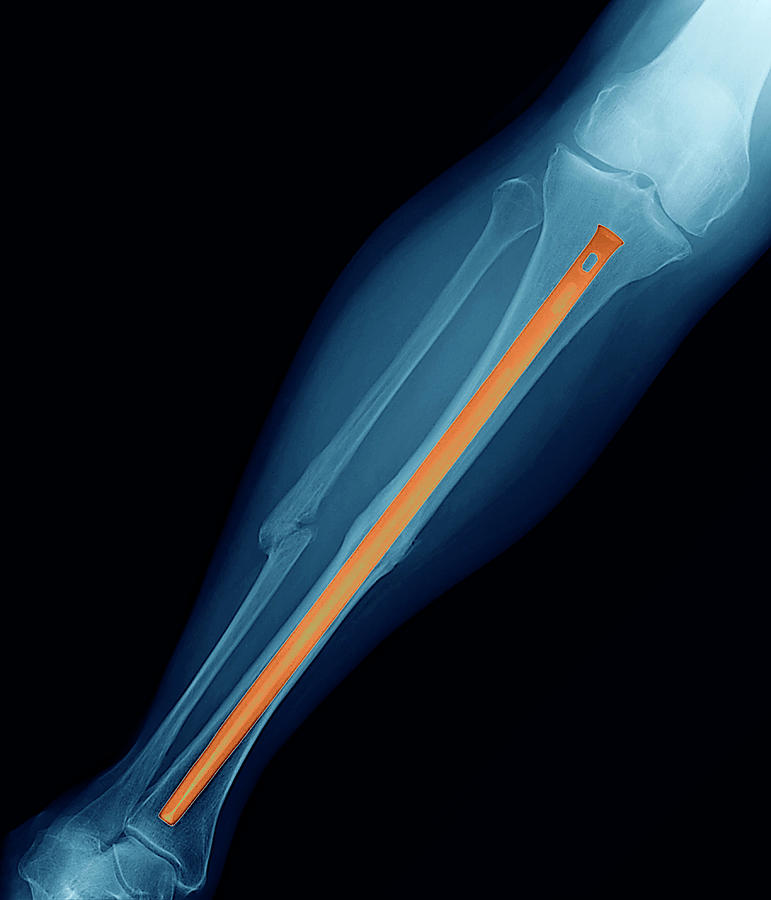 Pinned Broken Leg #2 by Zephyr / Science Photo Library