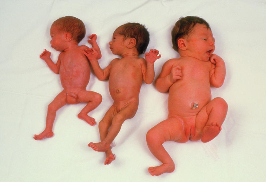 A Normal Baby And Two Low Birthweight Babies by Ron Sutherland ...