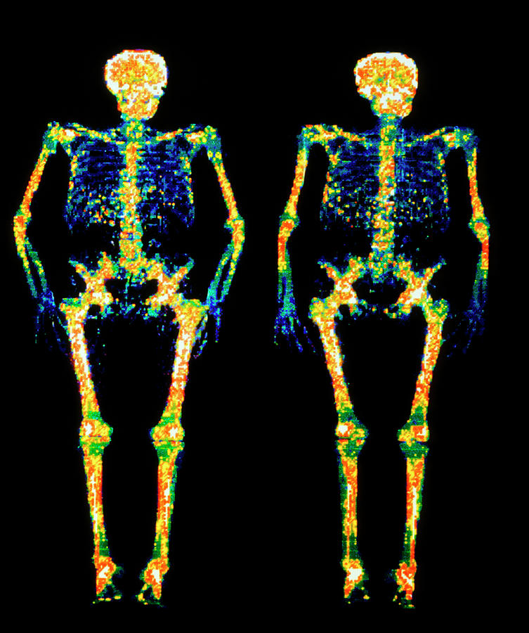 Bone Densitometry Scans Of The Skeletons Of Twins by Dr. Nigel Morrison ...