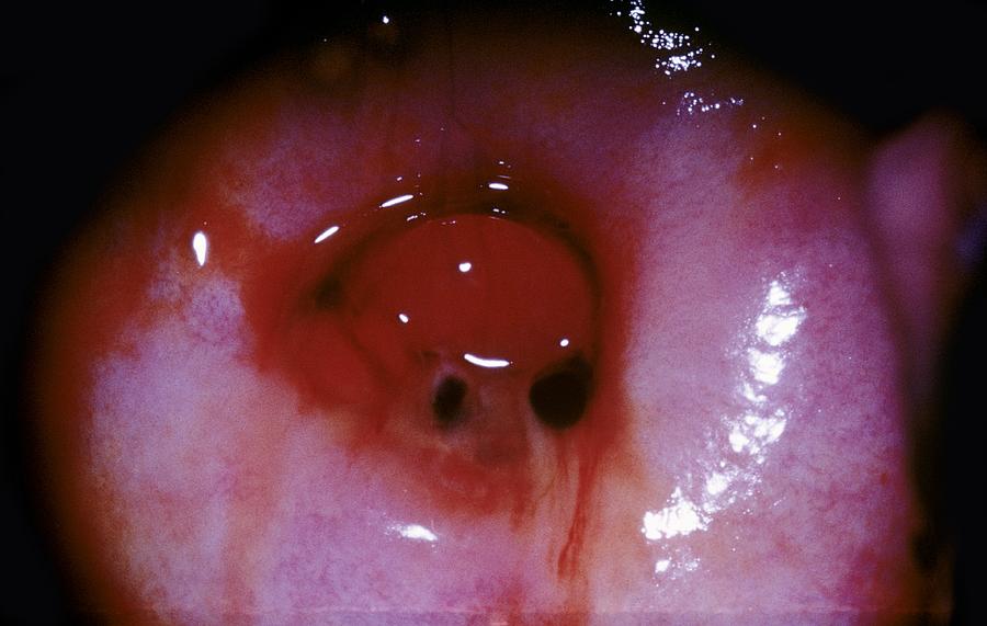Cervical polyp by Cnri / Science Photo Library