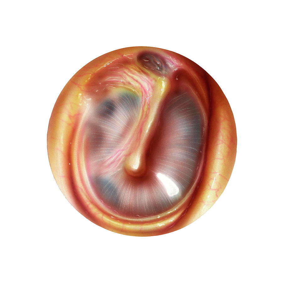 Eardrum by Bo Veisland / Science Photo Library