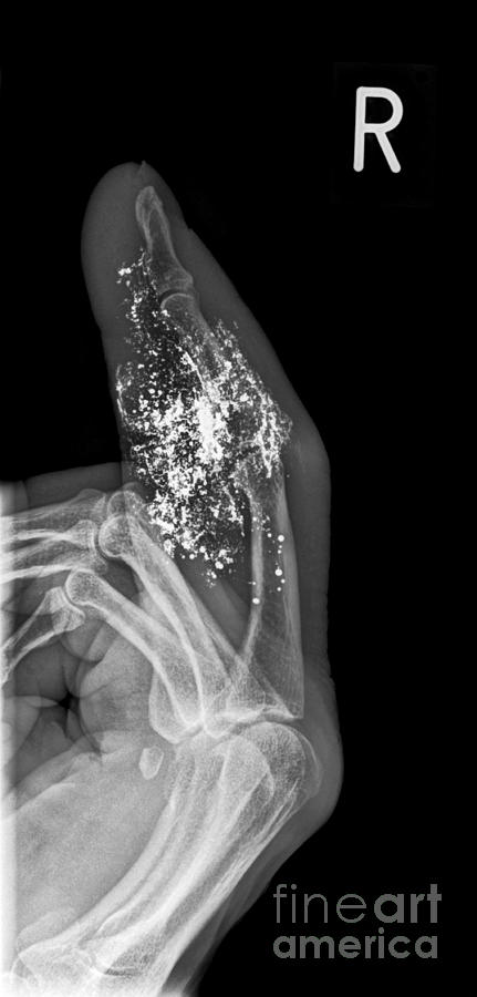 Foreign Body In Finger, X-ray by Science Photo Library