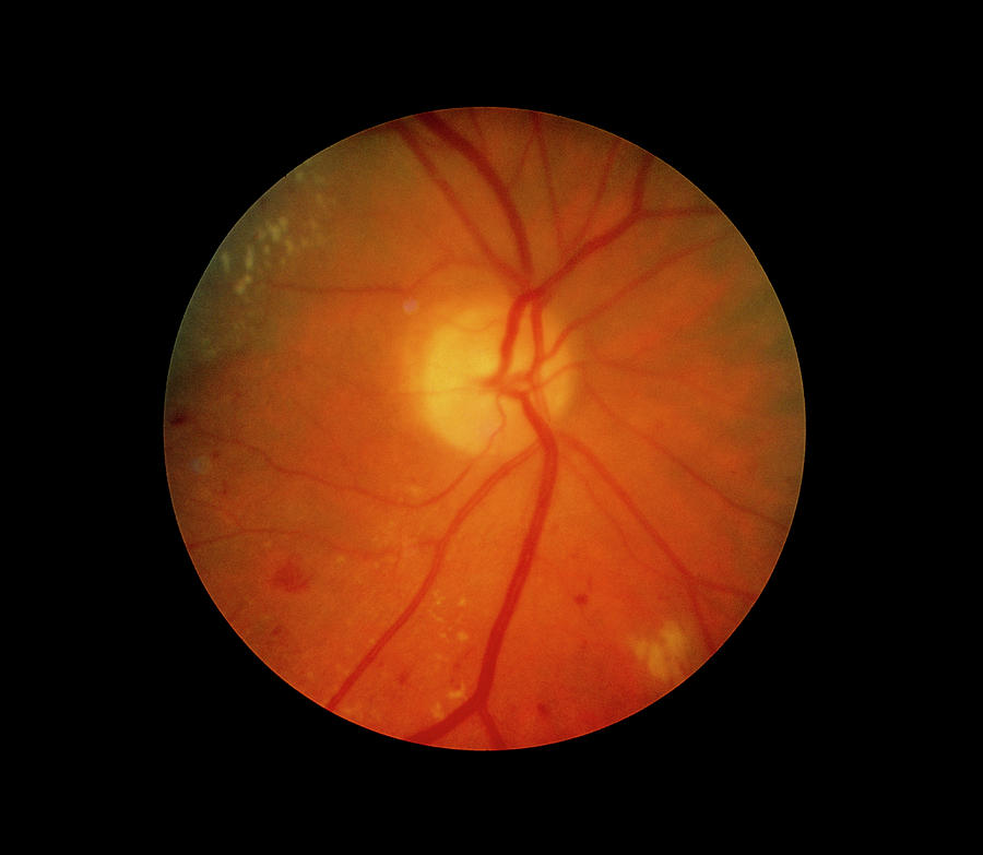 Fundus Camera Image: Mod-severe Diabetic Retinopty by Science Photo Library