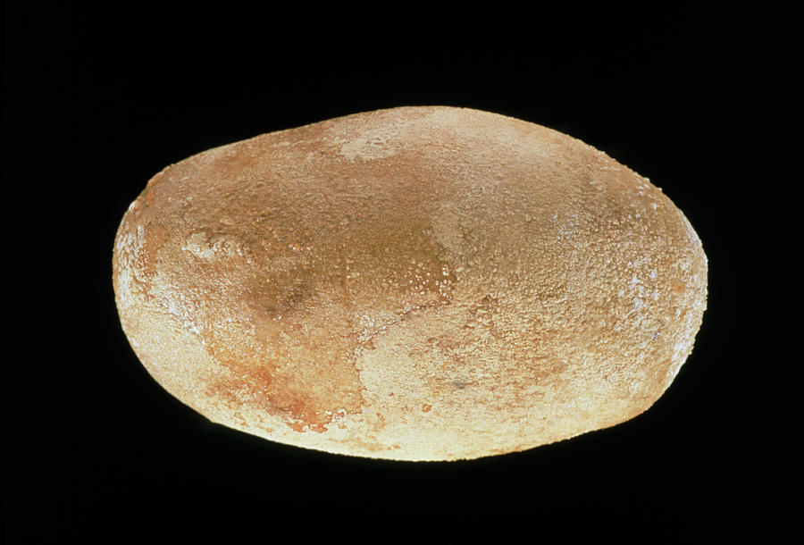 Human Gall Stone Removed From The Gall Bladder by Garry Watson ...