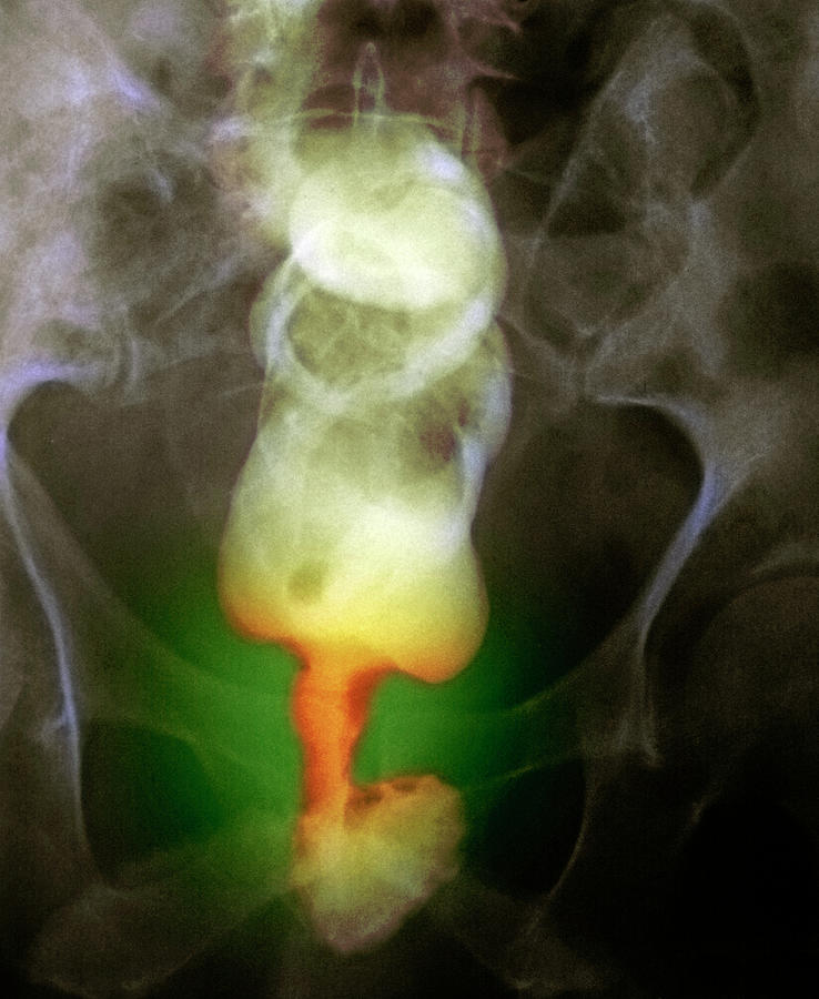 Narrowed Rectum by Cnri / Science Photo Library