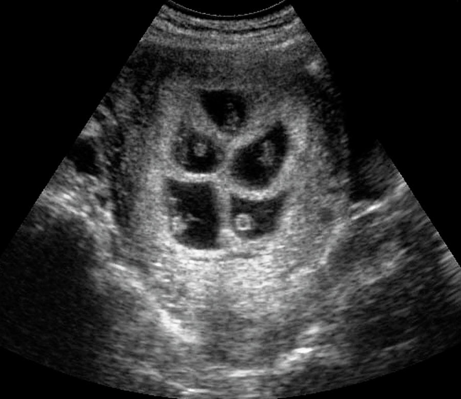 Quintuplet Foetuses by Dr Najeeb Layyous / Science Photo Library