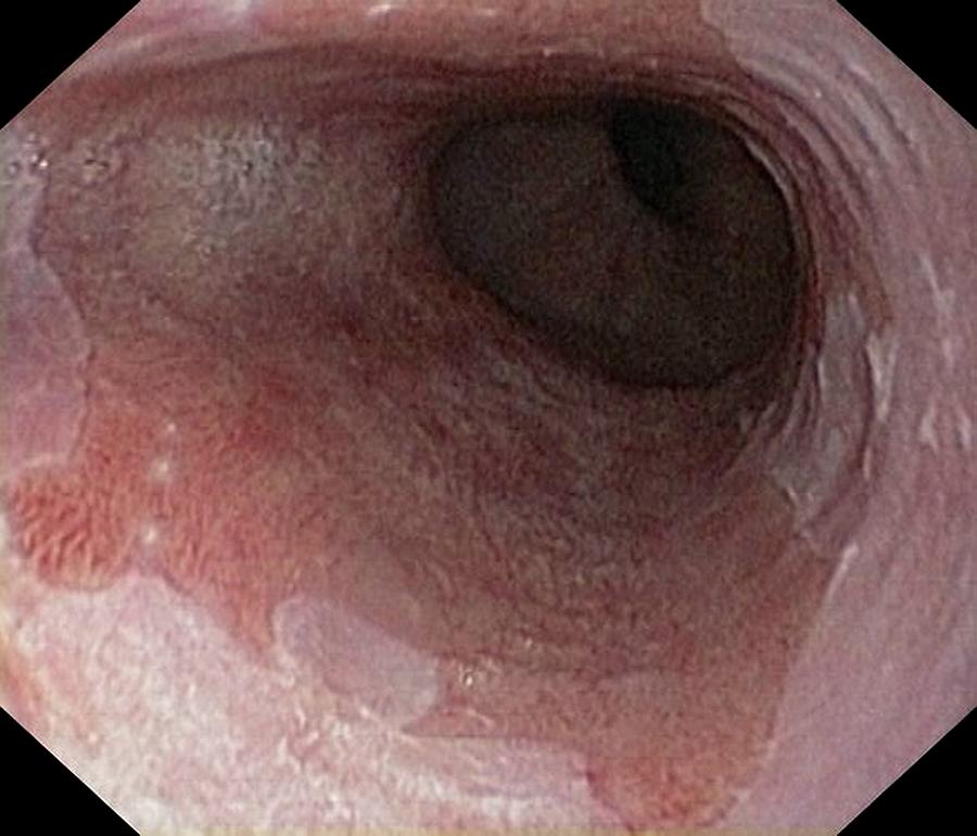 Barrett's Oesophagus Due To Reflux #1 by Gastrolab / Science Photo Library