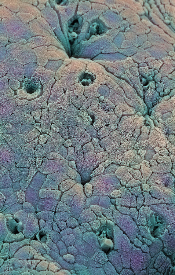 Rectal Polyp #1 by Steve Gschmeissner / Science Photo Library