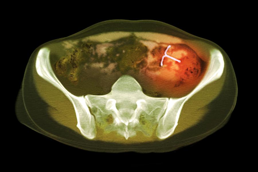 Ectopic Iud Contraceptive, Ct Scan #2 by Du Cane Medical Imaging Ltd ...