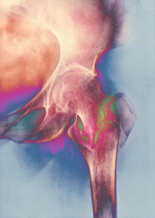Coloured X-ray Of Femur Fracture In Osteoporosis #3 by Medical Photo ...