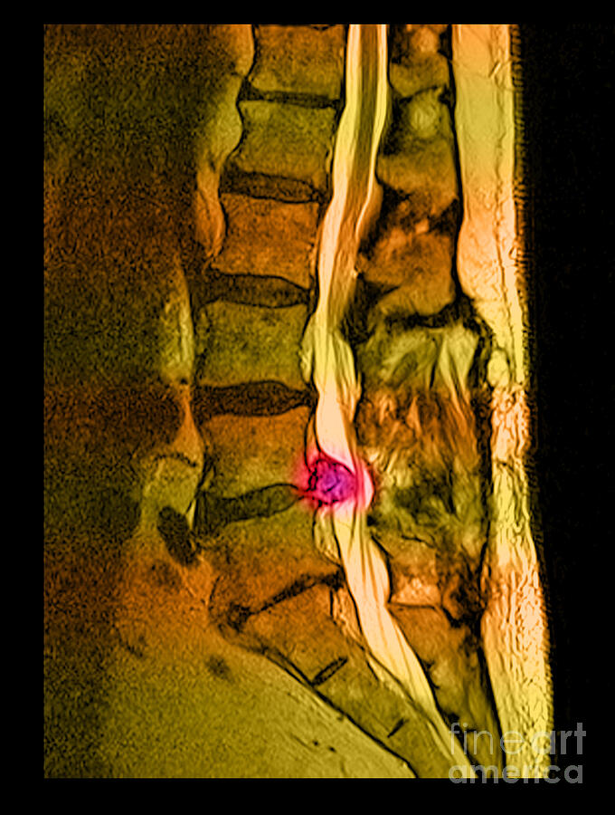 Herniated Disc, Lumbar Spine, MRI Medical Scan #4 by Medical Body Scans