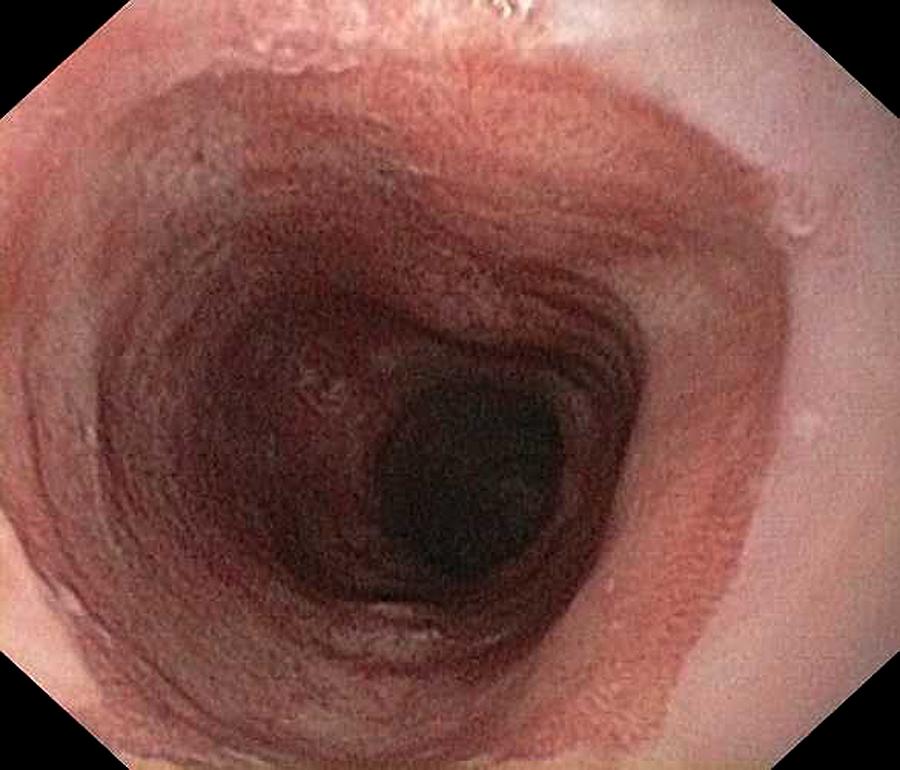 Barrett's Oesophagus Due To Reflux by Gastrolab / Science Photo Library