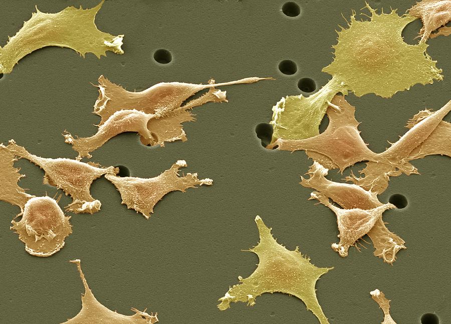 Cancer Cell Culture, Sem by Steve Gschmeissner / Science Photo Library