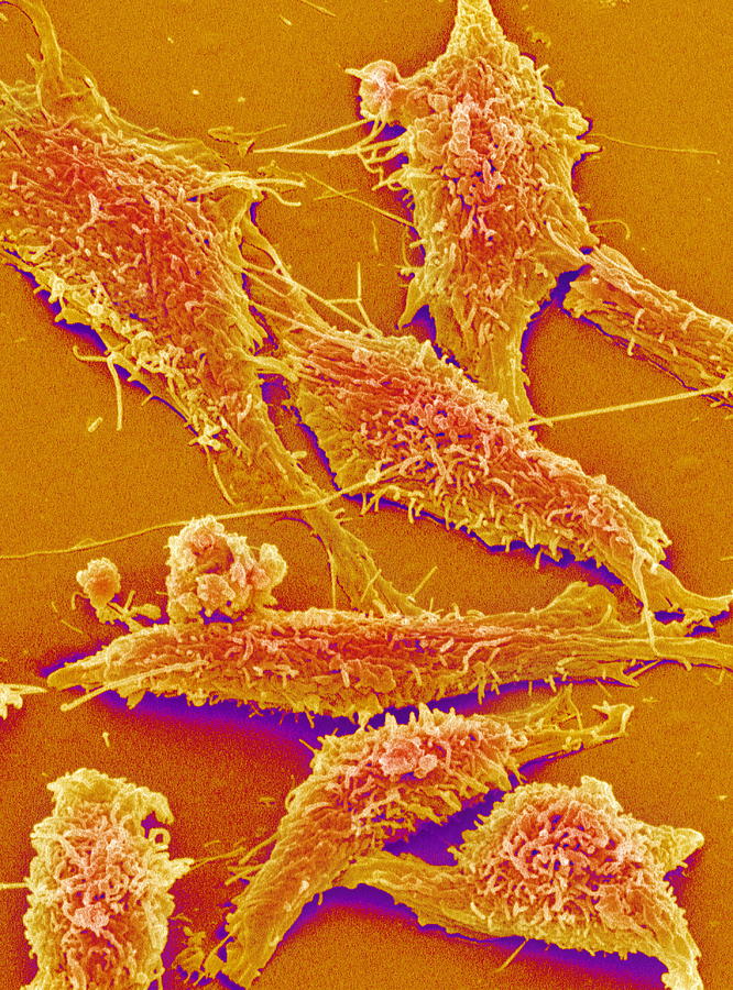Colon Cancer Cells,sem by Susumu Nishinaga / Science Photo Library