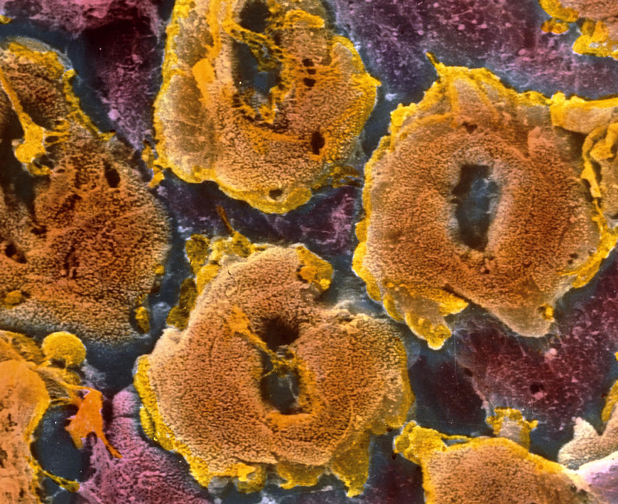 Colour Sem Of Human Colon With Ulcerative Colitis by Professors P.M ...