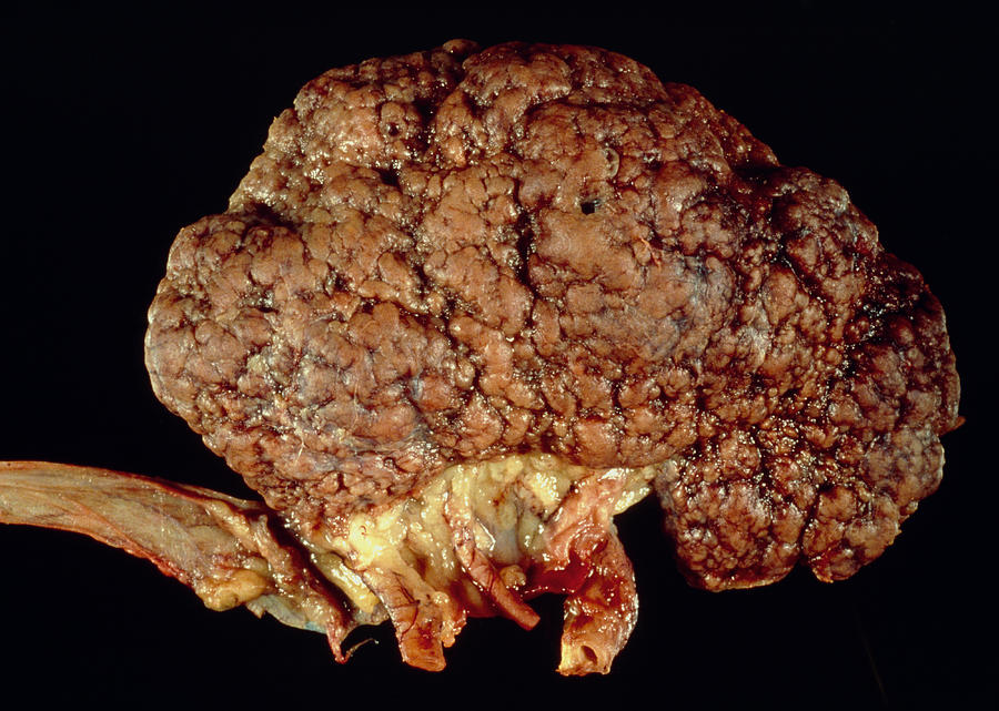 Gross Specimen Of Kidney Scarred By Hypertension by Dr. E. Walker ...
