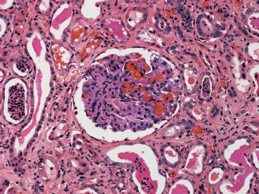 Inflamed Kidney, Light Micrograph by Steve Gschmeissner / Science Photo ...