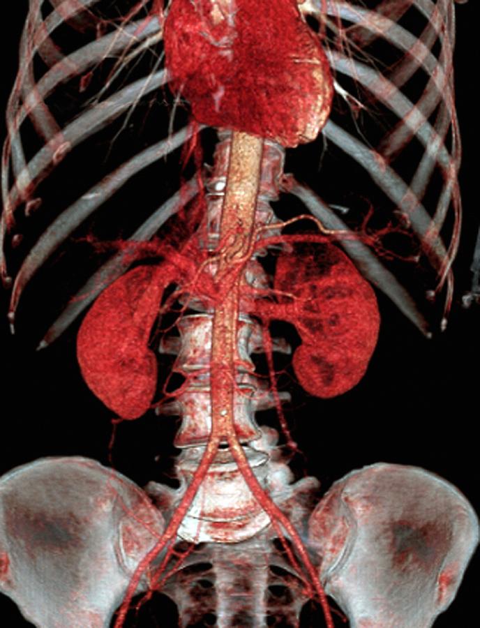 Normal Abdomen, 3d Ct Scan by Zephyr / Science Photo Library