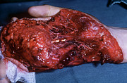 Degloving Injury Poster by Mike Devlin / Science Photo Library ...
