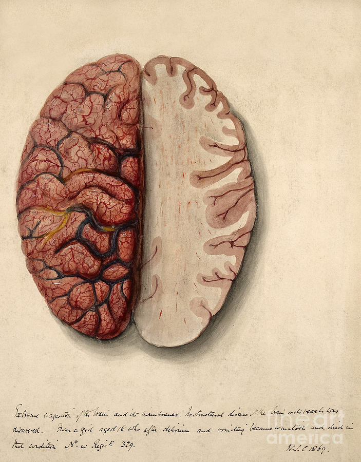 Brain, Extreme Congestion by Wellcome Images