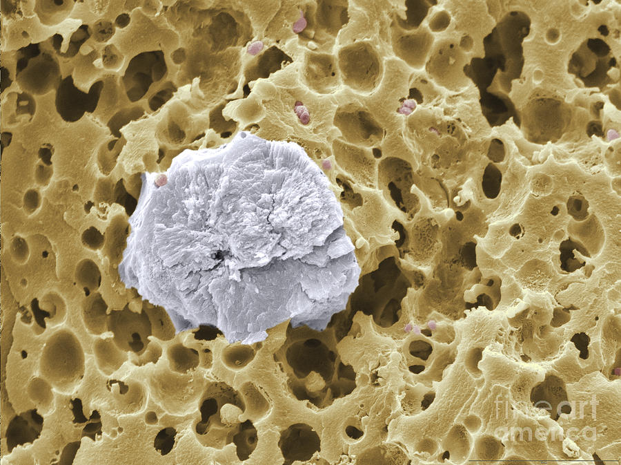 Calcium Phosphate Crystal Sem by Scimat