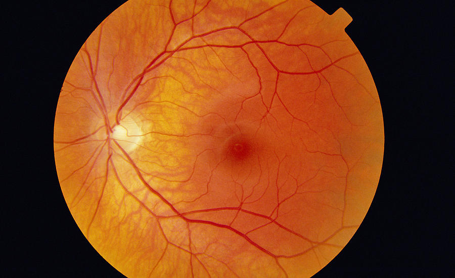 Healthy Retina by Paul Parker / Science Photo Library
