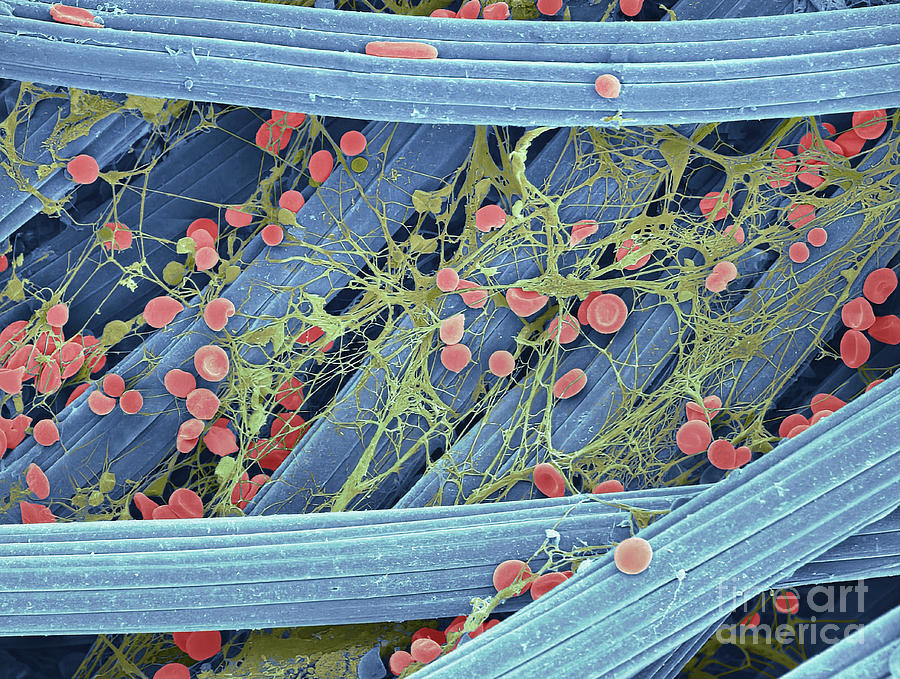 Blood Clot On Plaster #1 by Steve Gschmeissner / Science Photo Library