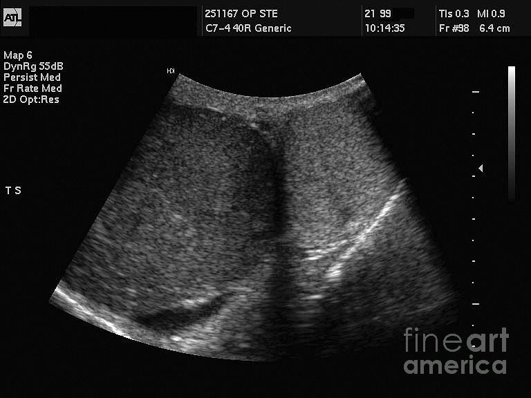 Inflamed Testis #1 by Simon Fraser / Science Photo Library