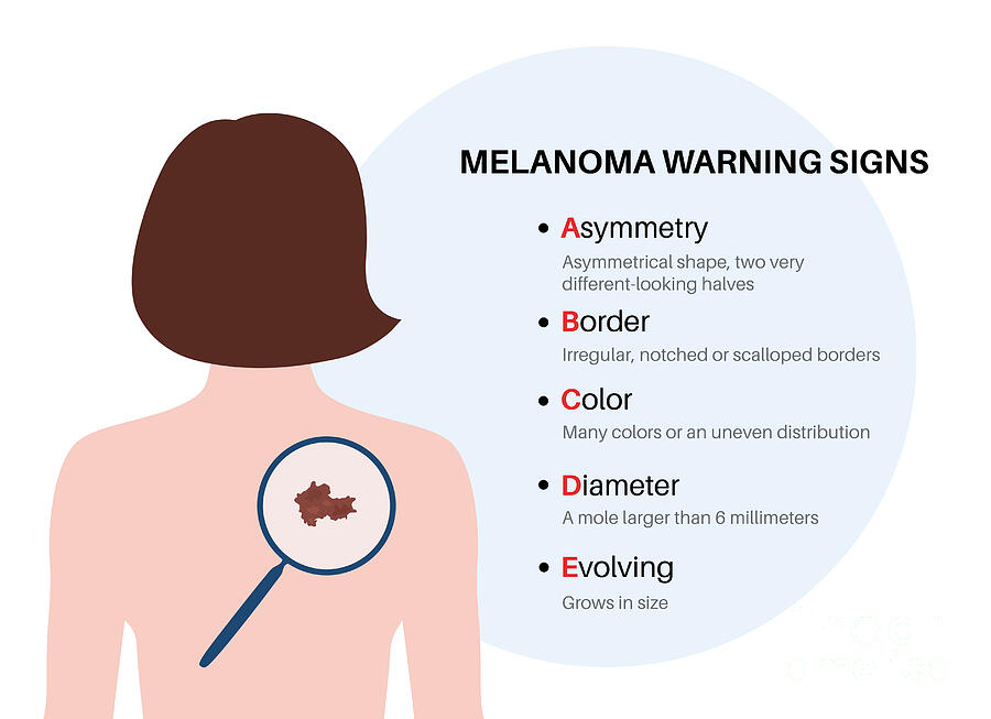 Melanoma Warning Signs #1 by Pikovit / Science Photo Library