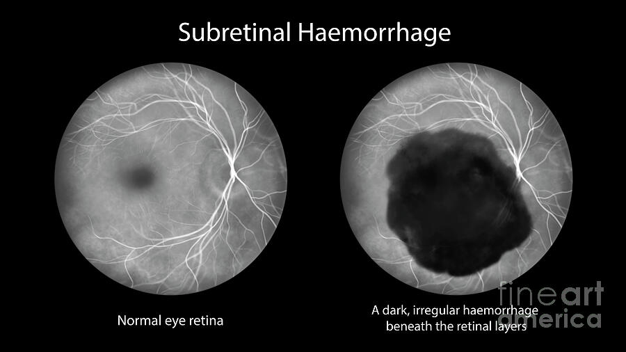Subretinal Haemorrhage On The Retina #1 by Kateryna Kon / Science Photo ...