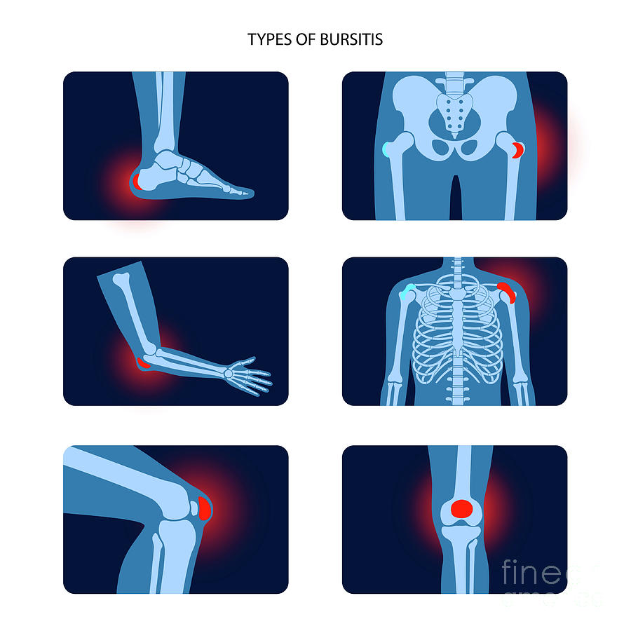 Types Of Bursitis #1 by Pikovit / Science Photo Library