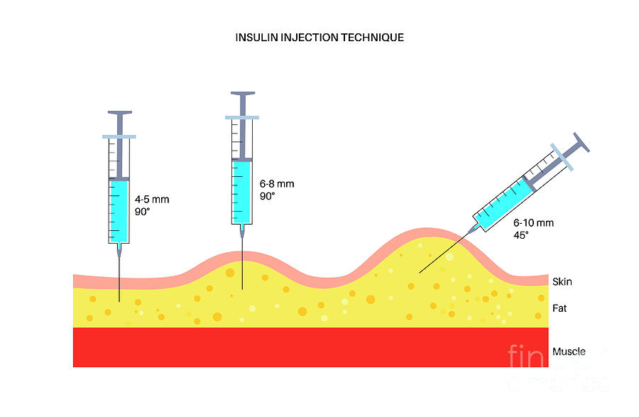 Insulin Injection Sites #10 by Pikovit / Science Photo Library