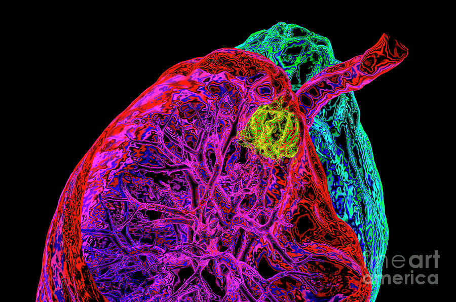 Lung Cancer #13 by K H Fung / Science Photo Library