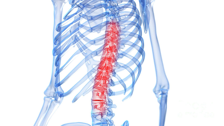 Painful Spine #14 by 3Dmedisphere / Science Photo Library