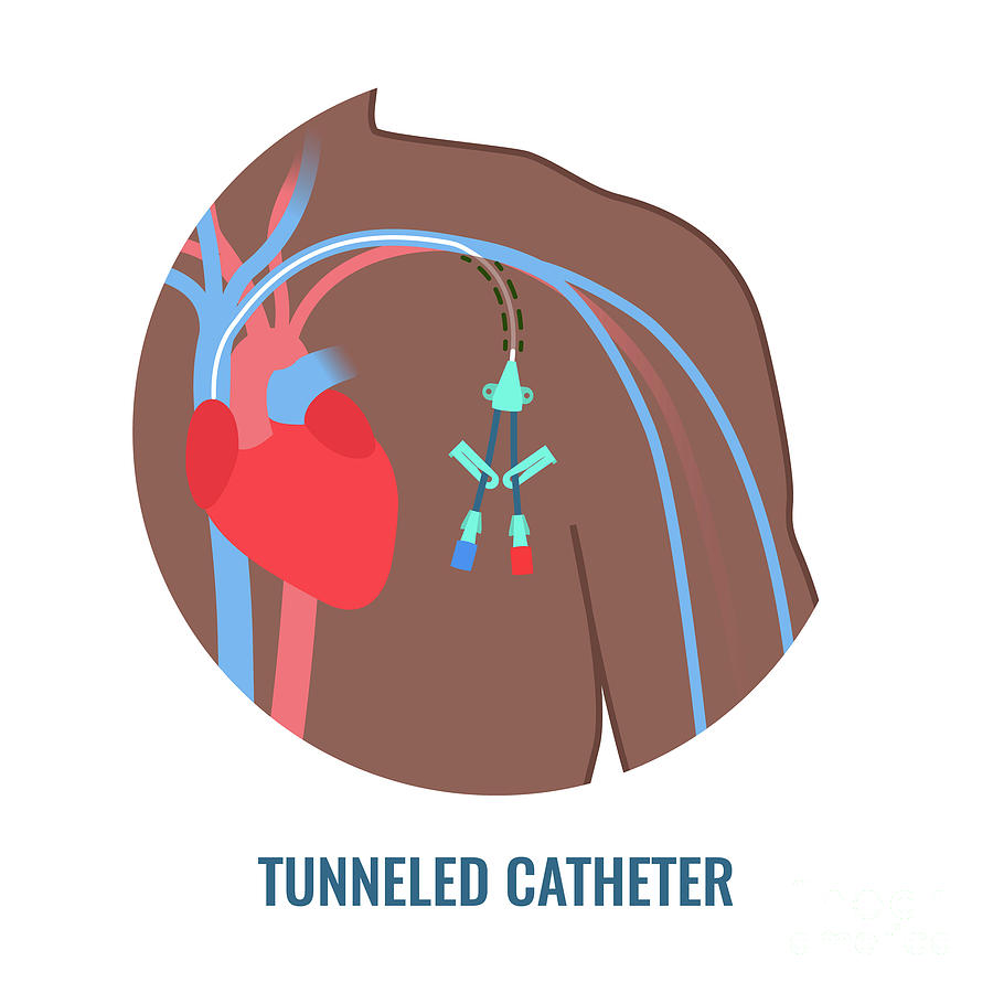 Central Venous Catheter #19 by Art4Stock / Science Photo Library