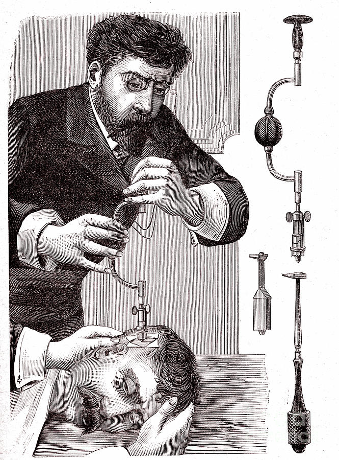 19th Century Trepanning Treatment by Collection Abecasis / Science ...
