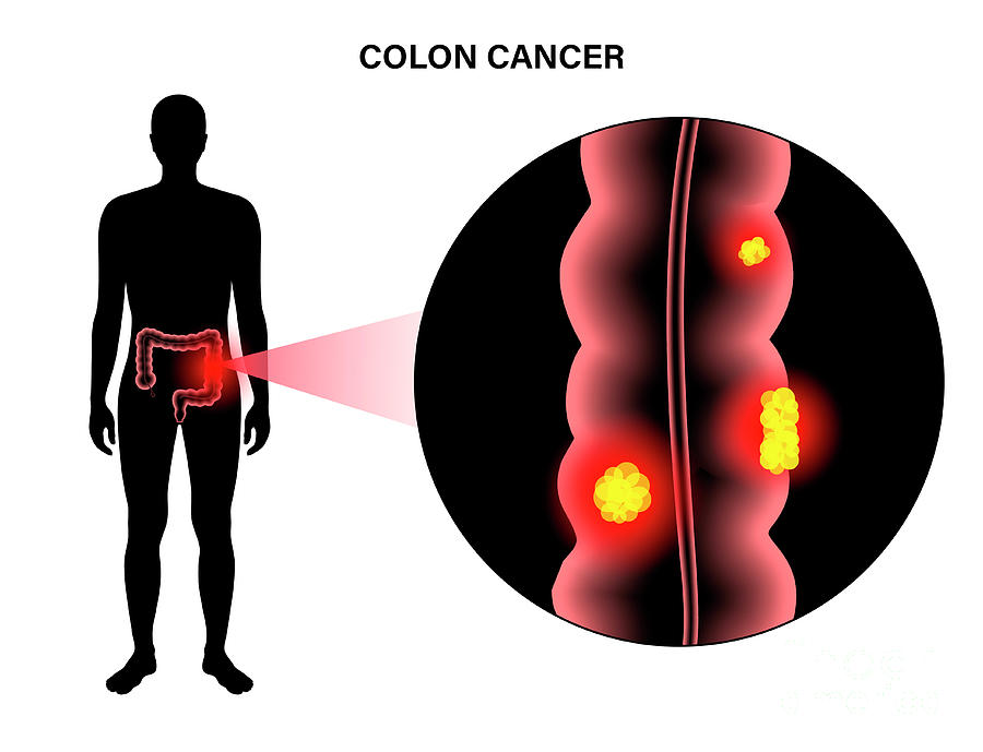 Intestinal Cancer #2 by Pikovit / Science Photo Library