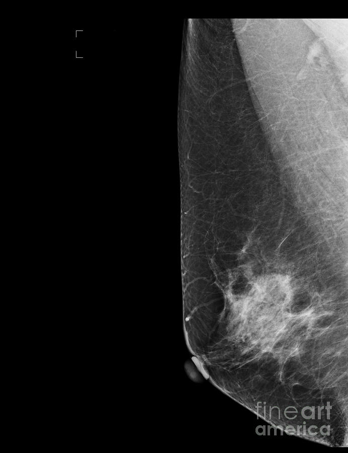 Normal Mammogram #2 by Samunella / Science Photo Library