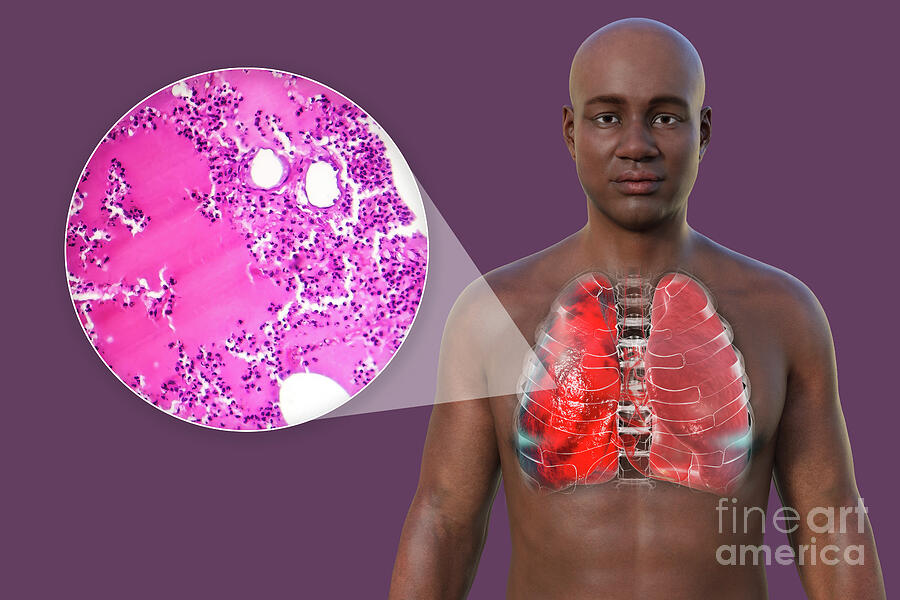Man With Lungs Affected By Pneumonia #27 by Kateryna Kon / Science ...