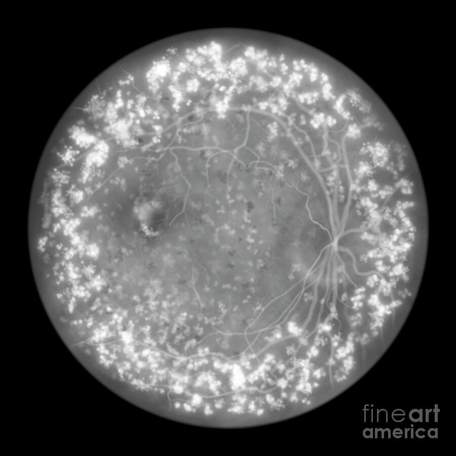 Autosomal Dominant Vitreoretinochoroidopathy #3 by Kateryna Kon ...