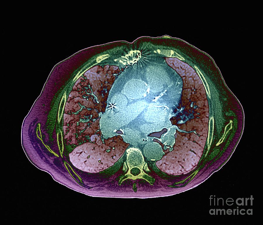 Cardiac Decompensation #3 by Zephyr / Science Photo Library